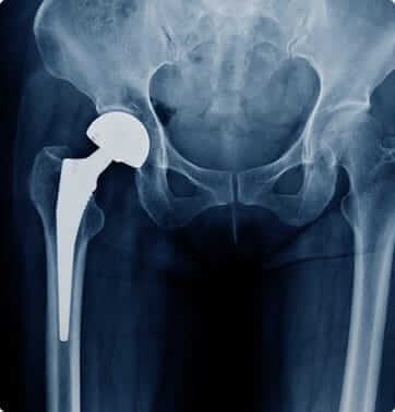 Joint Replacement Surgery | Osteoarthritis Treatment | OAWJ